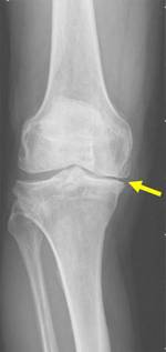 Knieendoprothetik: UKM - Allgemeine Orthopädie und Tumororthopädie