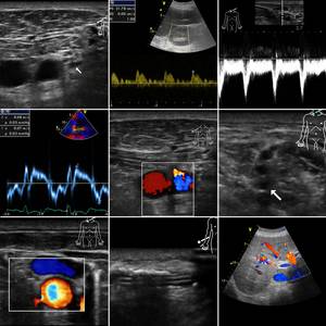 Kinder-Ultraschallkurs: UKM - Anästhesiologie und operative Intensivmedizin